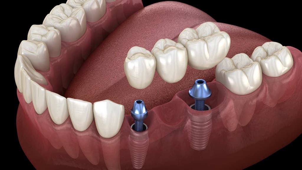 Single tooth dental implants: Replace your missing tooth today ...